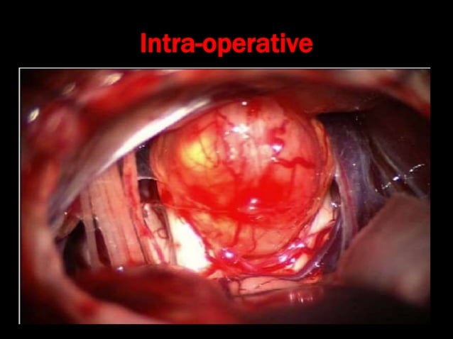 Vestibular schwannoma and glomus tumors | PPT