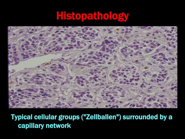 Vestibular schwannoma and glomus tumors | PPT