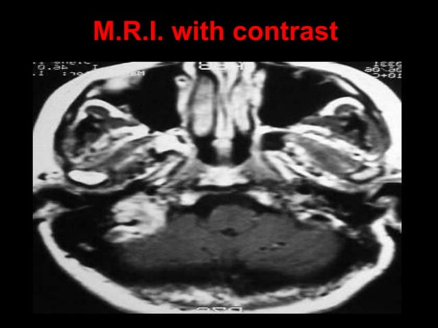 Vestibular schwannoma and glomus tumors | PPT