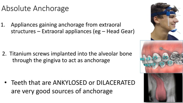 Tooth movement bio histo | PPT