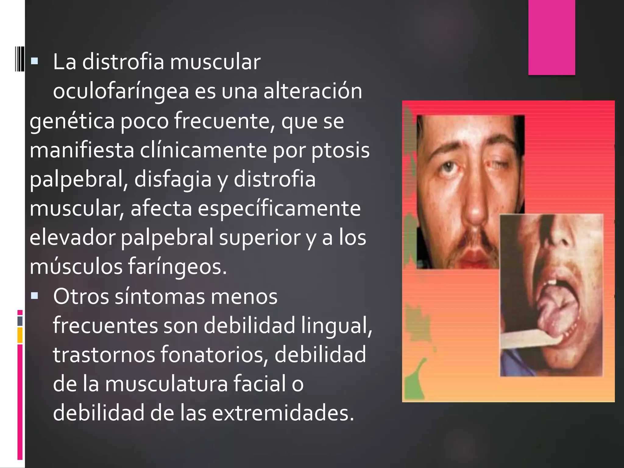 Distrofia muscular oculofaringea | PPT