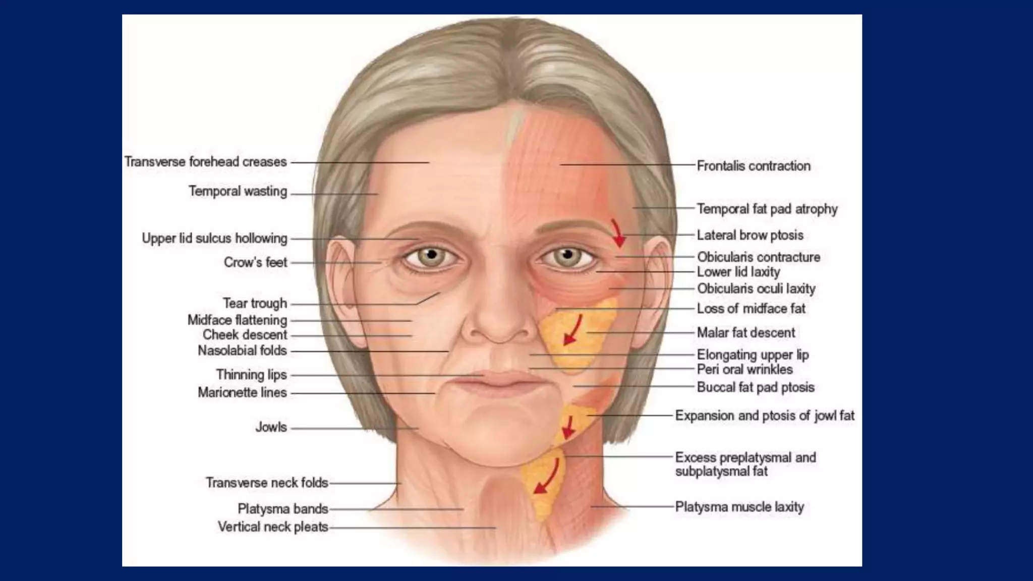 Face lift - Rhytidectomy | PPTX