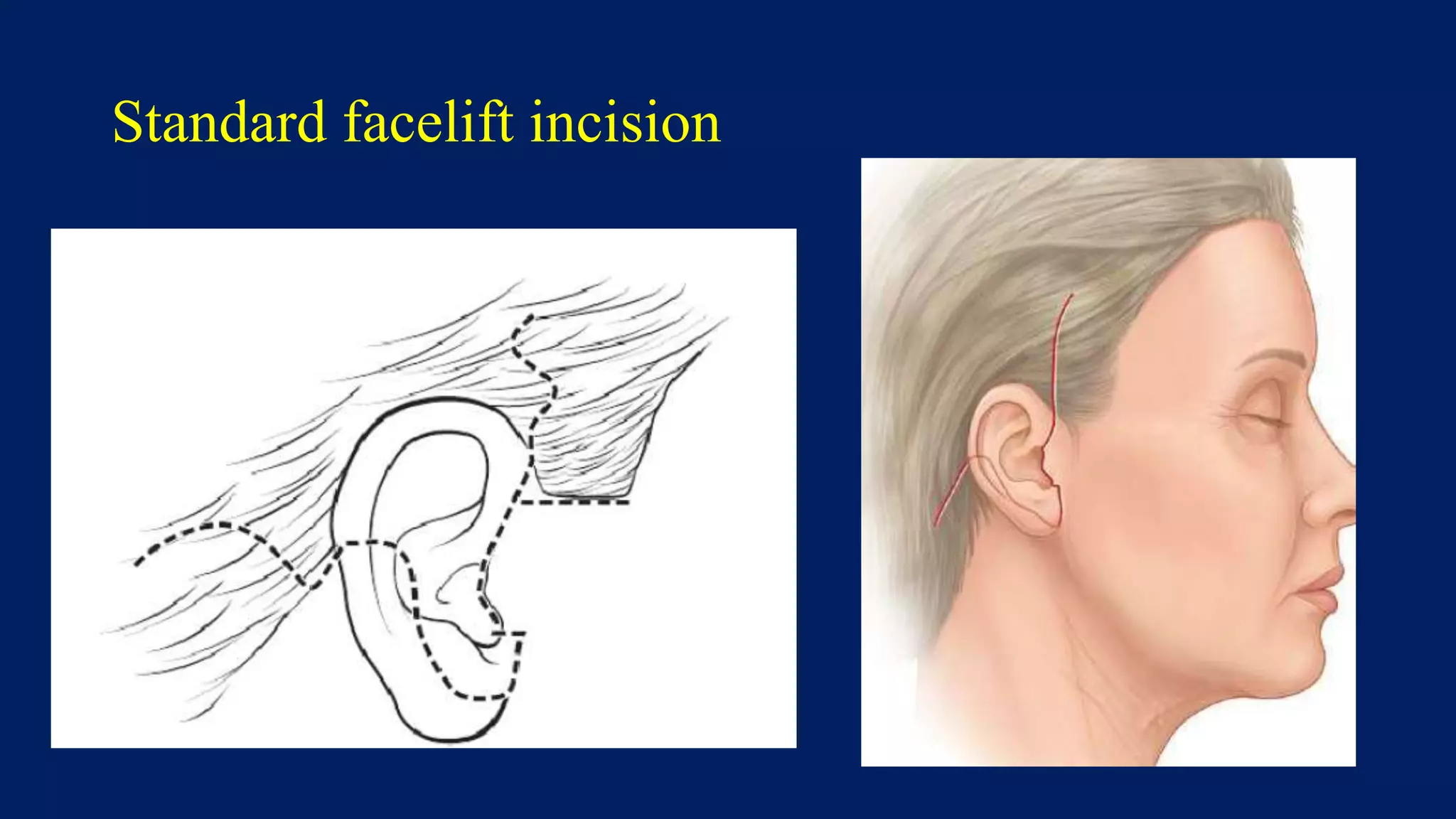 Face lift - Rhytidectomy | PPTX