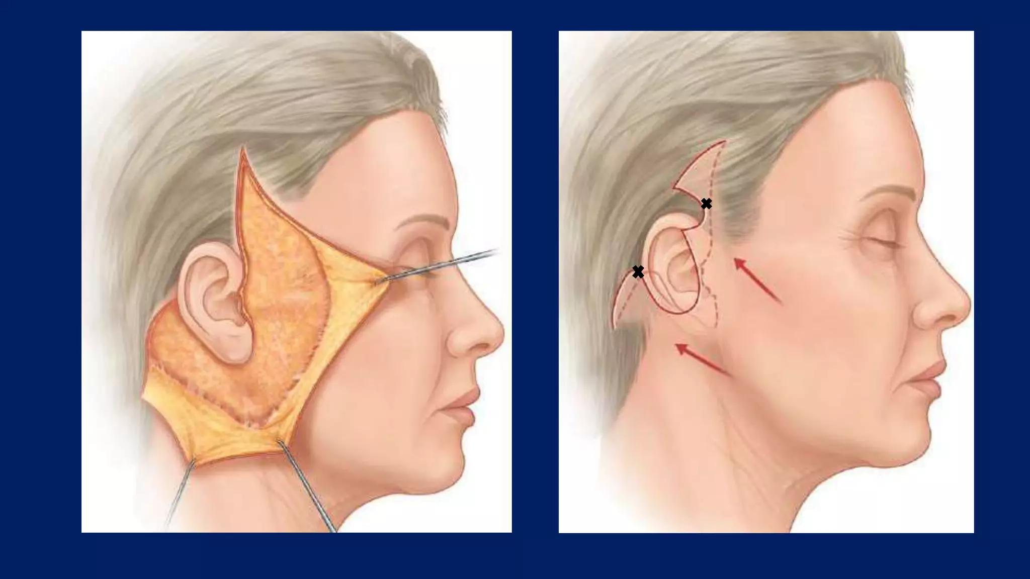 Face lift - Rhytidectomy | PPTX