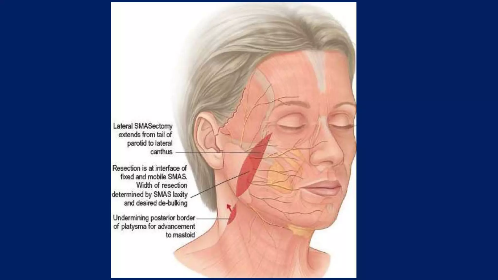 Face lift - Rhytidectomy | PPTX