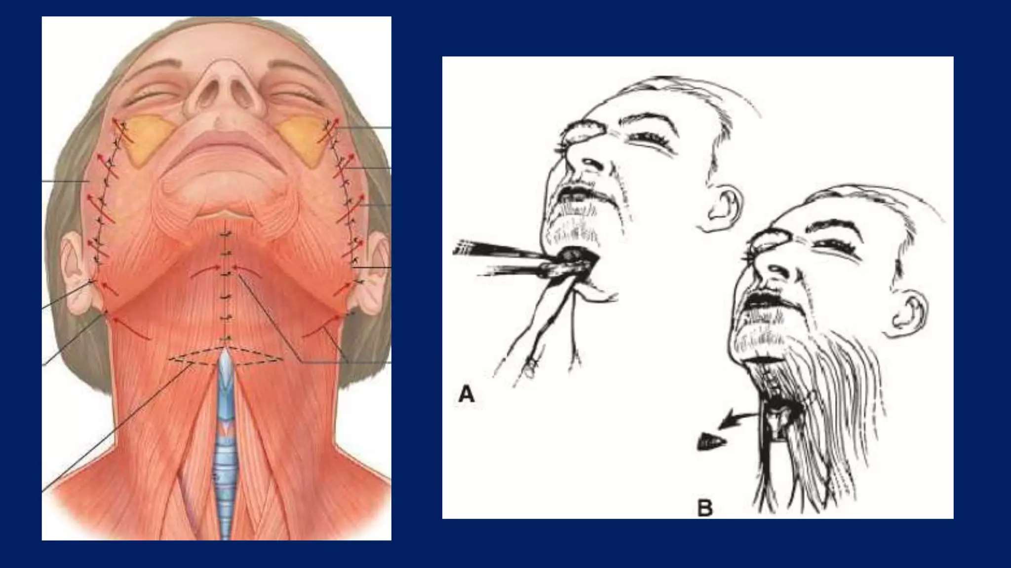 Face lift - Rhytidectomy | PPTX