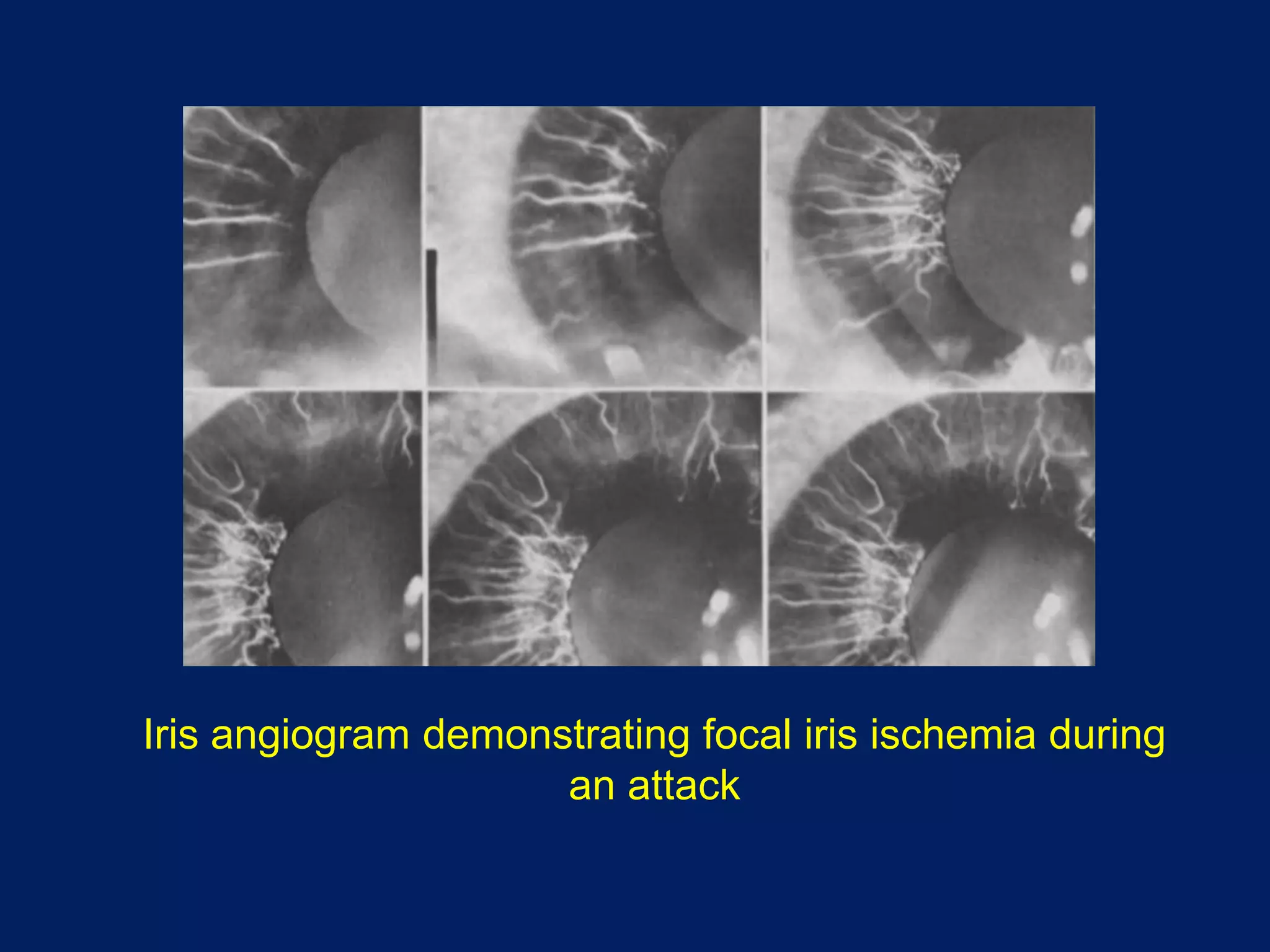 Posner schlossmann syndrome | PPT