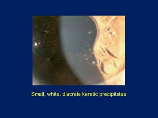 Posner schlossmann syndrome | PPT