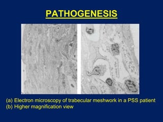 Posner schlossmann syndrome | PPT | Eye and Vision Conditions ...