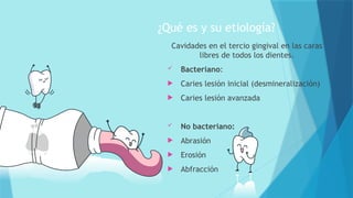 CLASE V , diseños de cavidades en la operatoria dental | PPTX