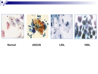 18.Cervical Cancer | PPT