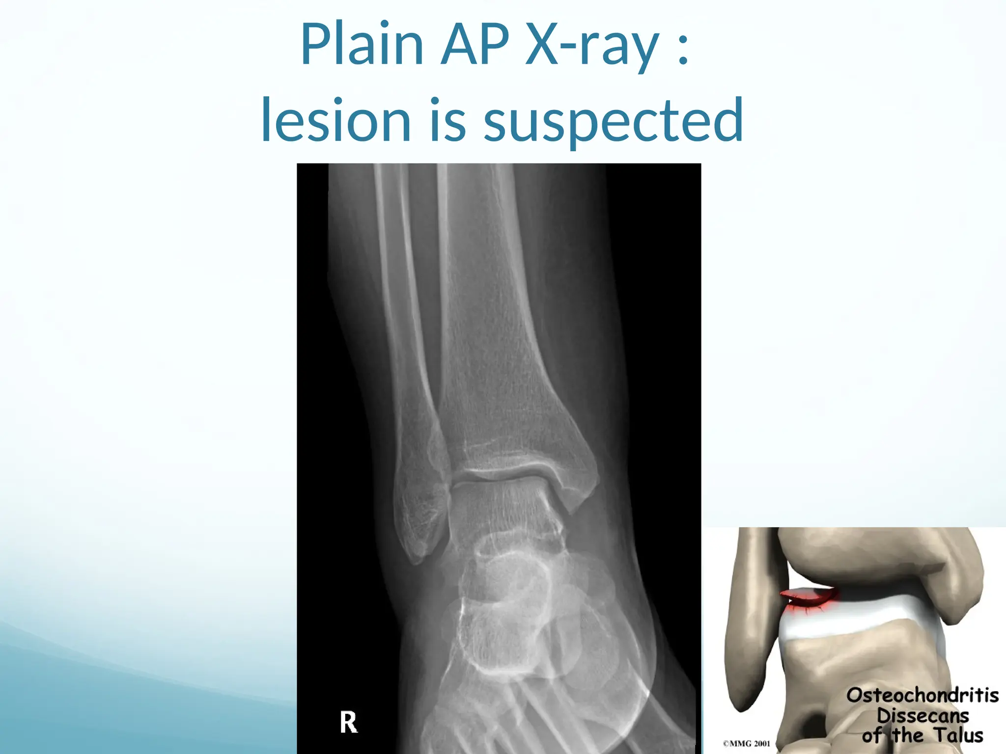 18-Common foot and ankle disorders orthopaedics.ppt