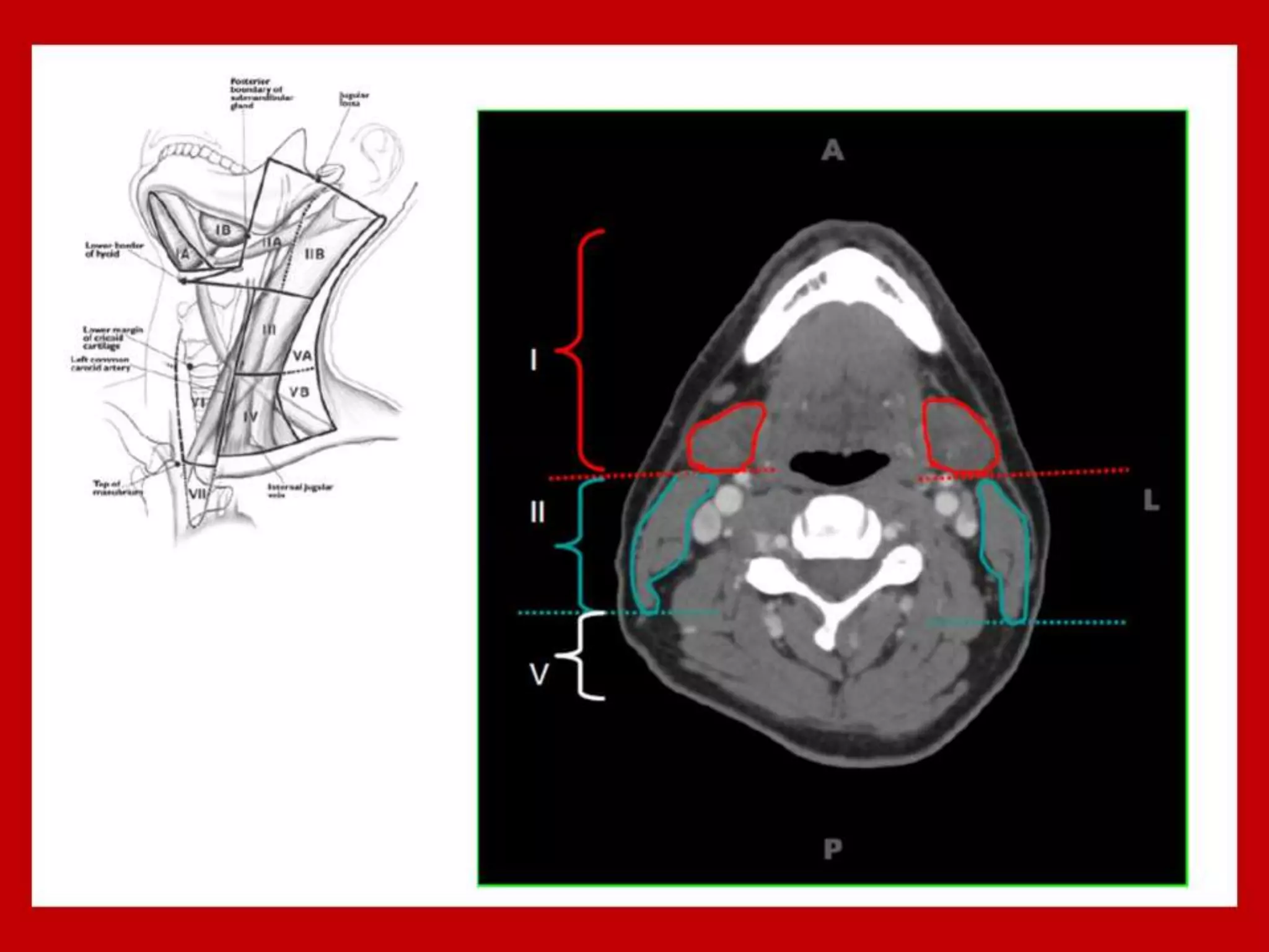 18 Dr Ahmed Esawy imaging oral board of larynx imaging | PPT
