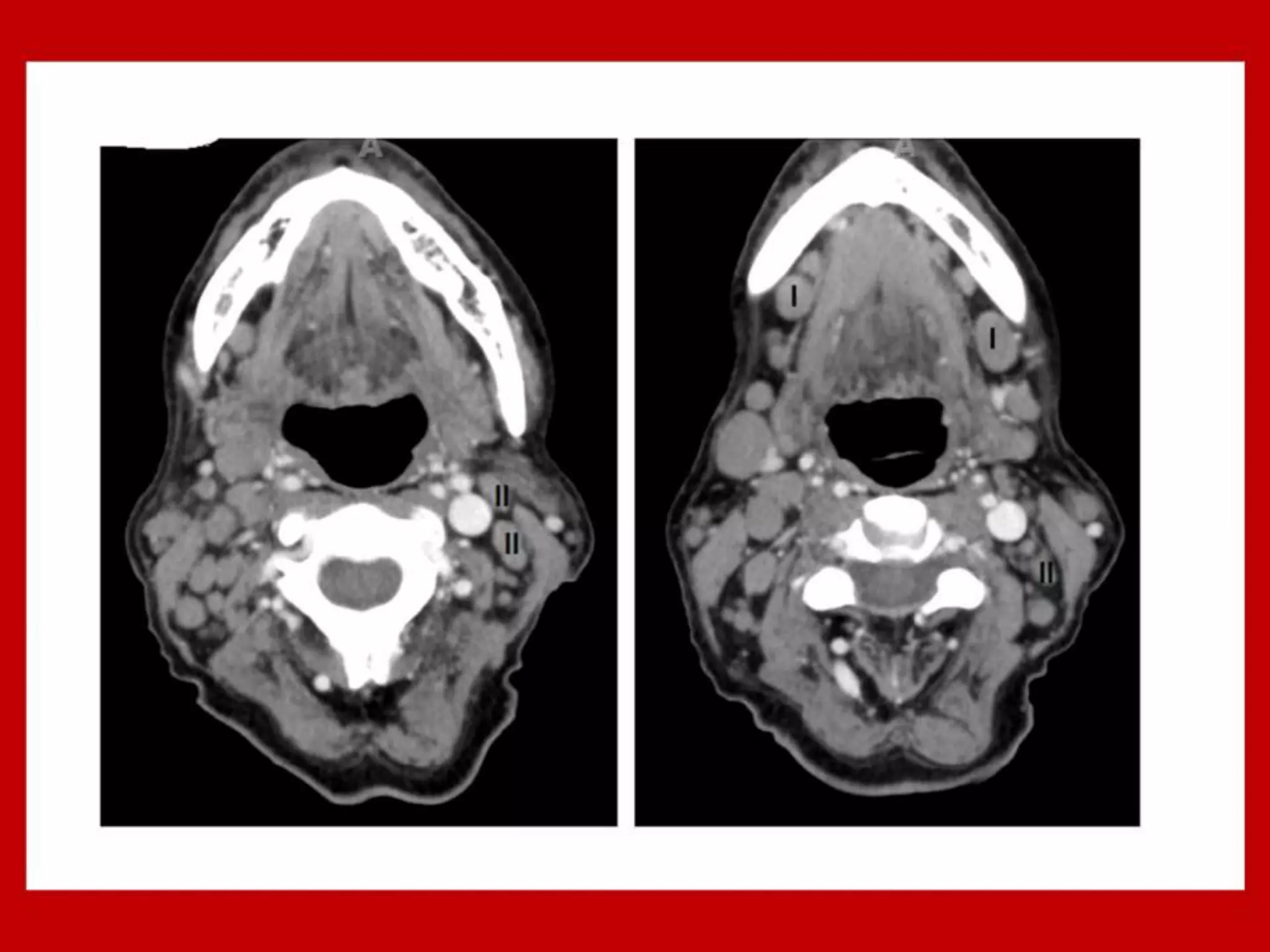 18 Dr Ahmed Esawy imaging oral board of larynx imaging | PPT