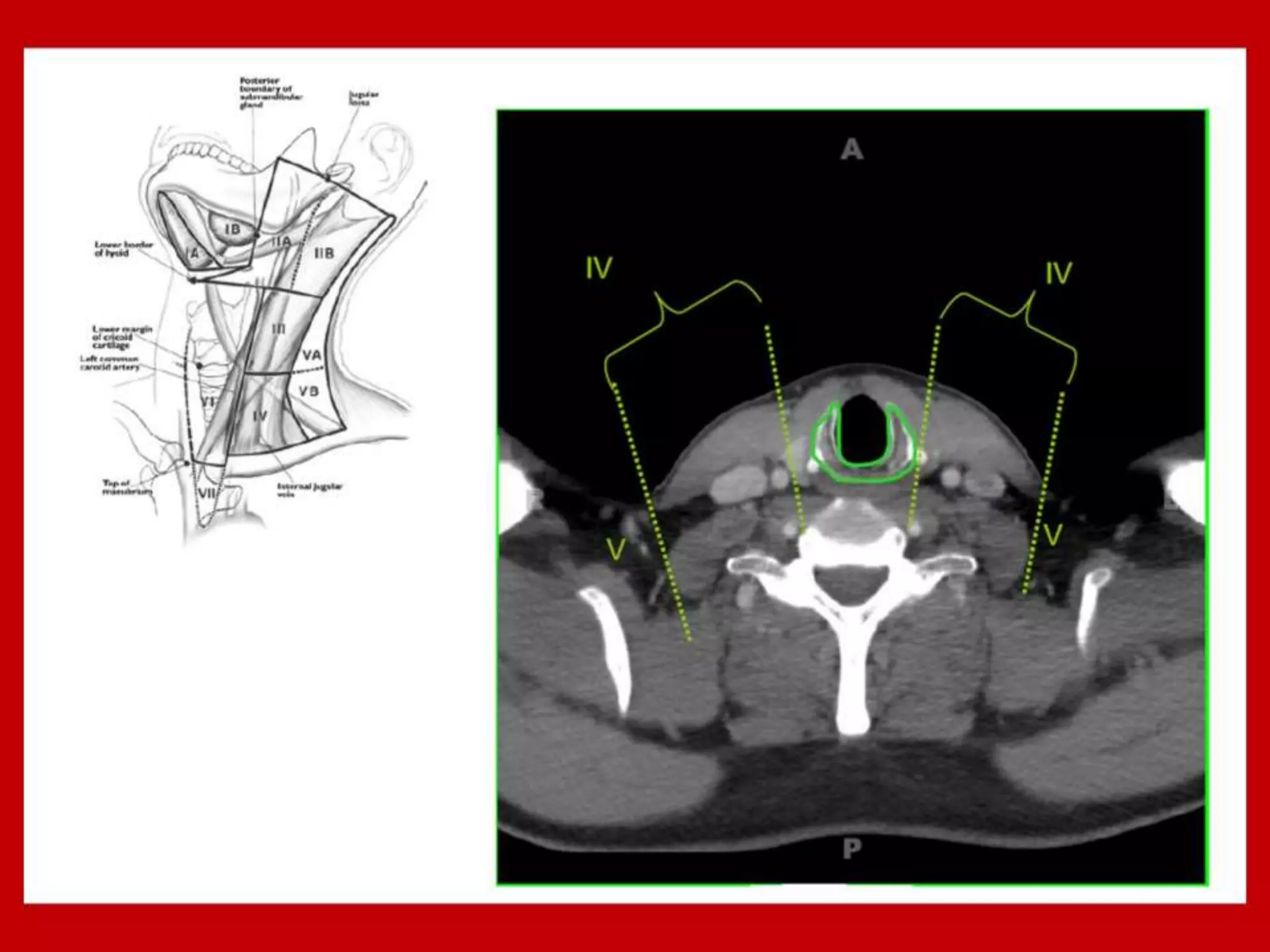 18 Dr Ahmed Esawy imaging oral board of larynx imaging | PPT