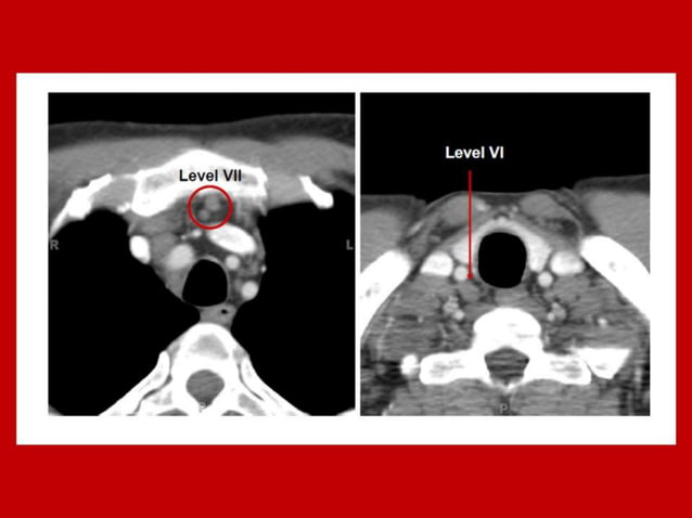 18 Dr Ahmed Esawy imaging oral board of larynx imaging | PPT