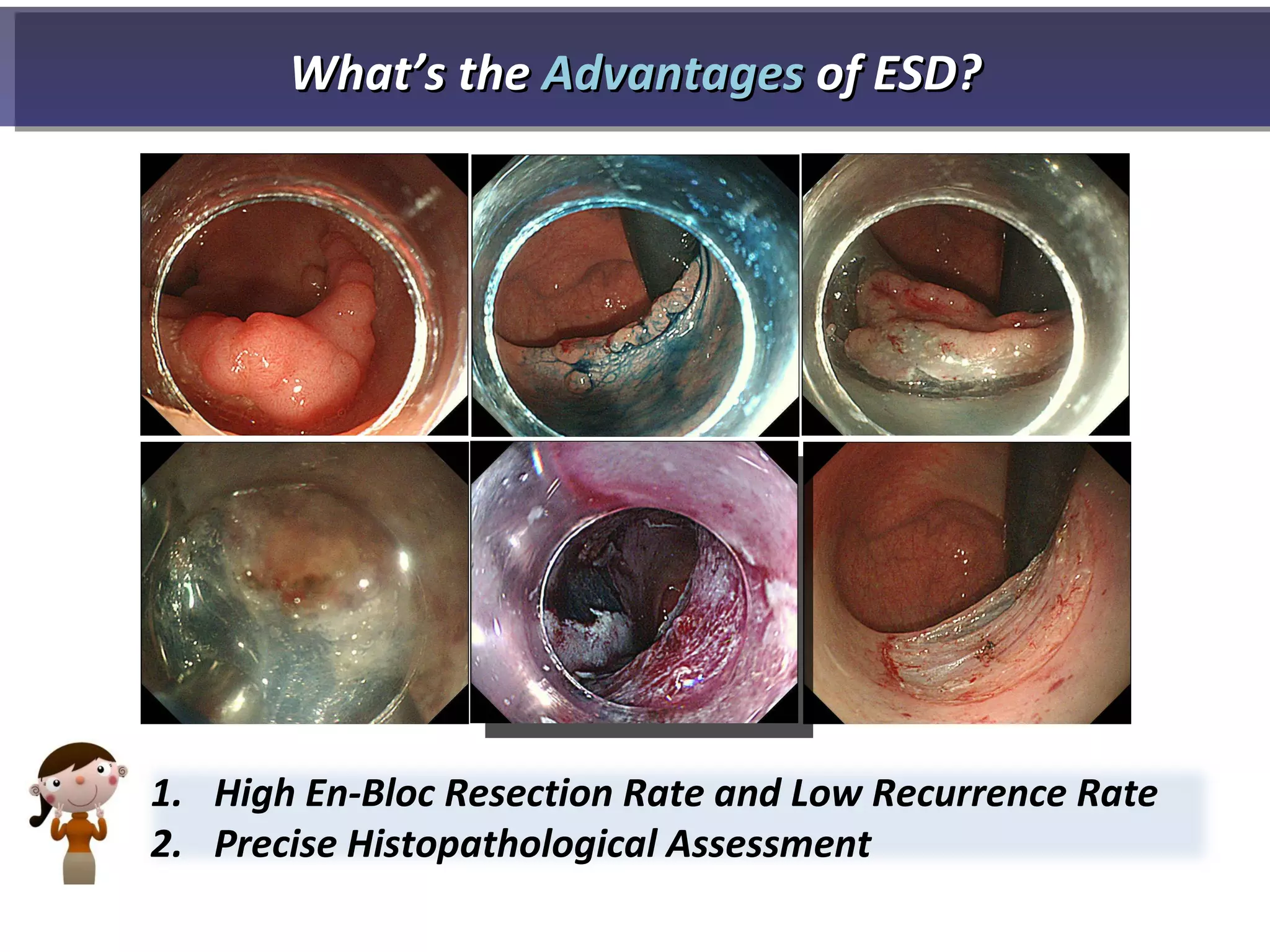 Endoscopy in Gastrointestinal Oncology - Slide 18 - T. Matsuda ...
