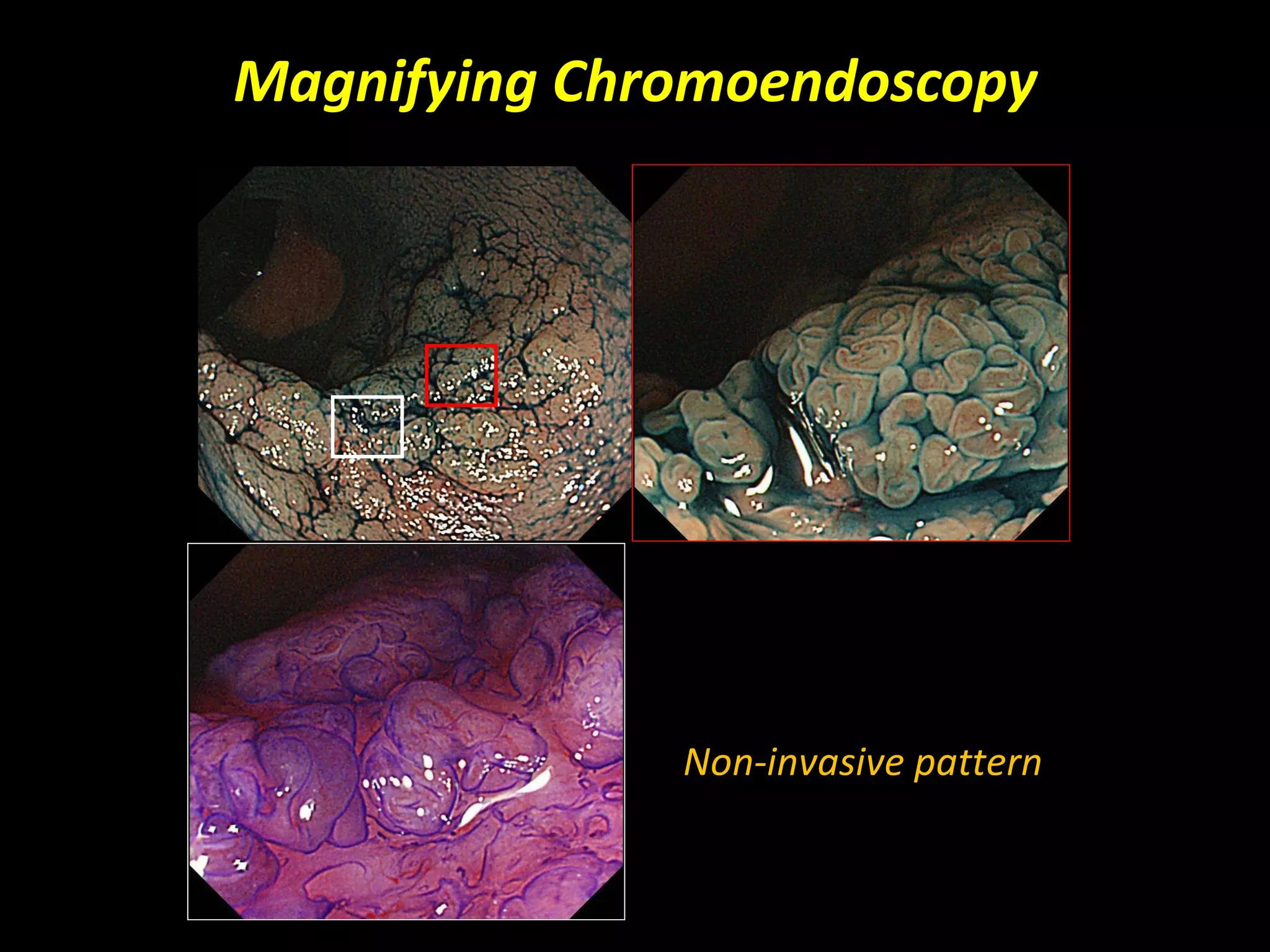 Endoscopy in Gastrointestinal Oncology - Slide 18 - T. Matsuda ...