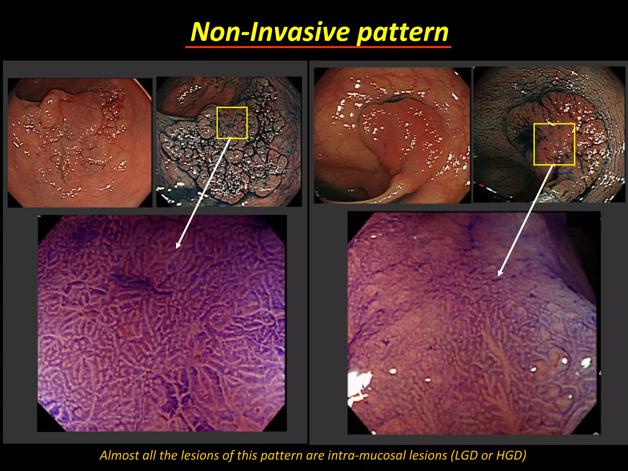 Endoscopy in Gastrointestinal Oncology - Slide 18 - T. Matsuda ...