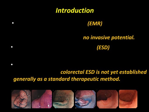 Endoscopy in Gastrointestinal Oncology - Slide 18 - T. Matsuda ...
