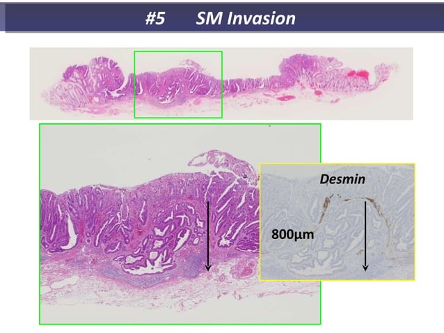 Endoscopy in Gastrointestinal Oncology - Slide 18 - T. Matsuda ...