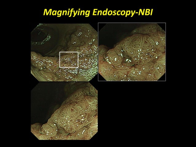 Endoscopy in Gastrointestinal Oncology - Slide 18 - T. Matsuda ...
