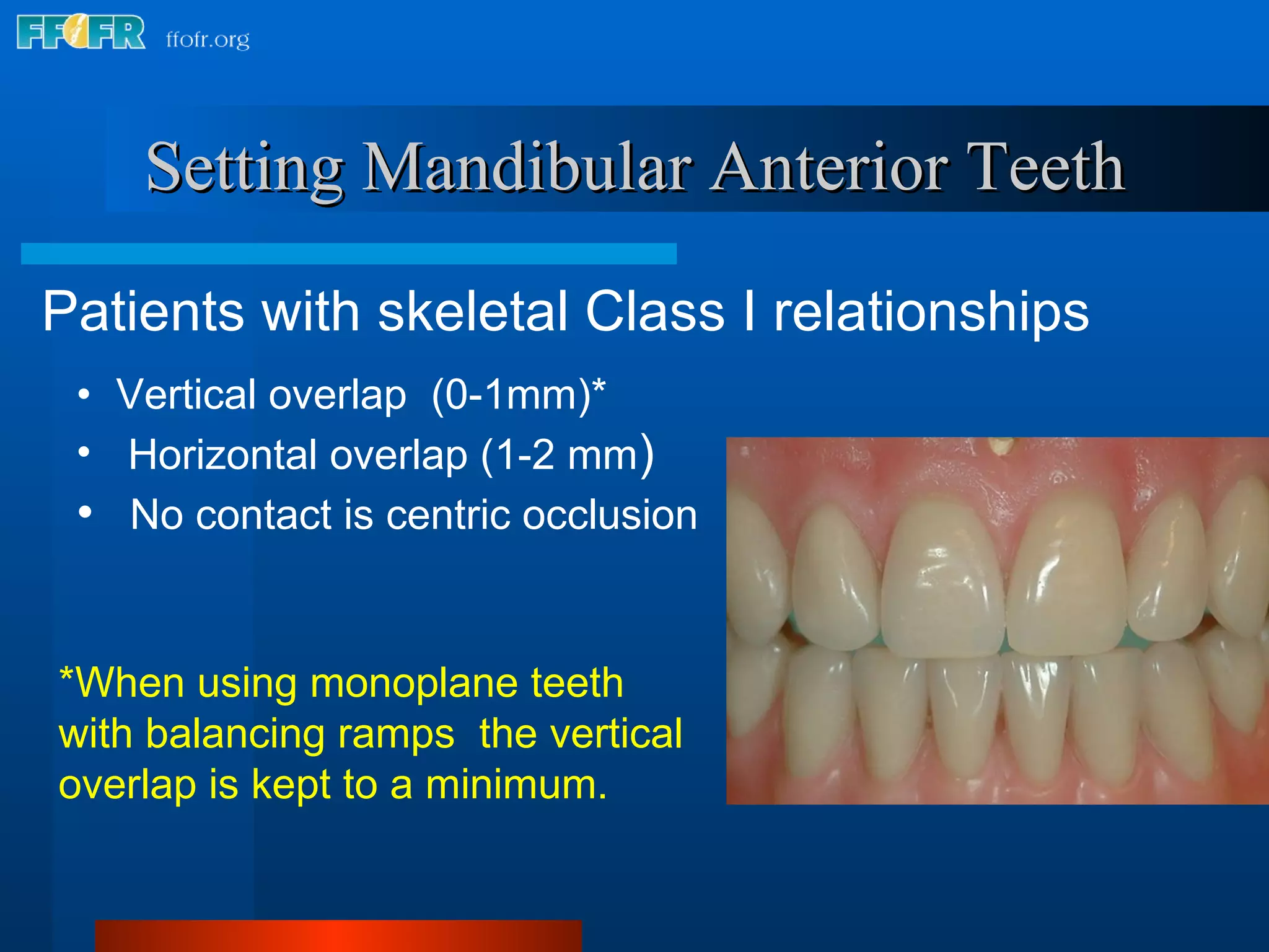 18.occlusal schemes monoplane with balancing ramps | PPT
