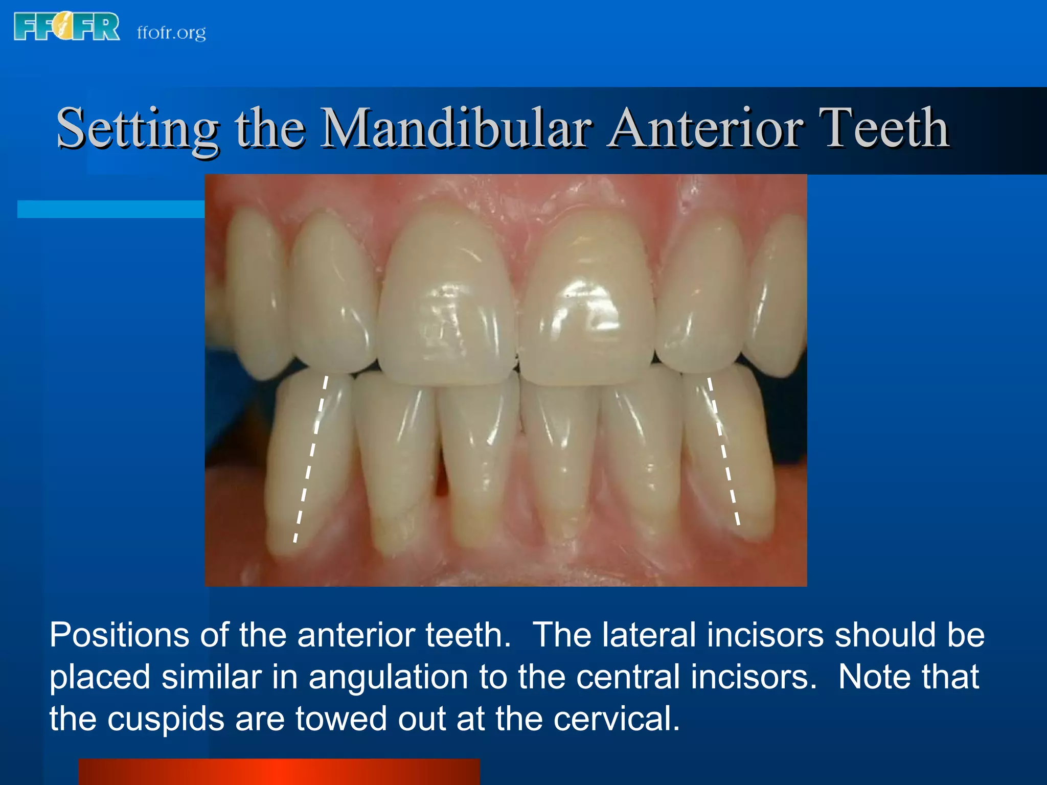 18.occlusal schemes monoplane with balancing ramps | PPT