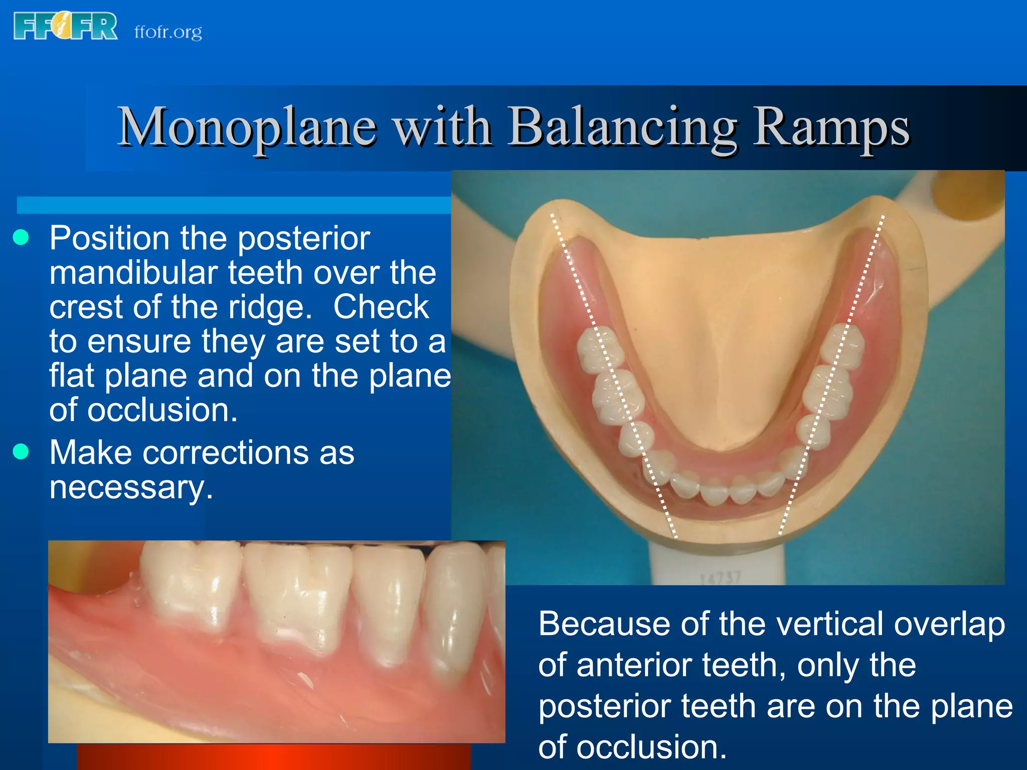 18.occlusal schemes monoplane with balancing ramps | PPT