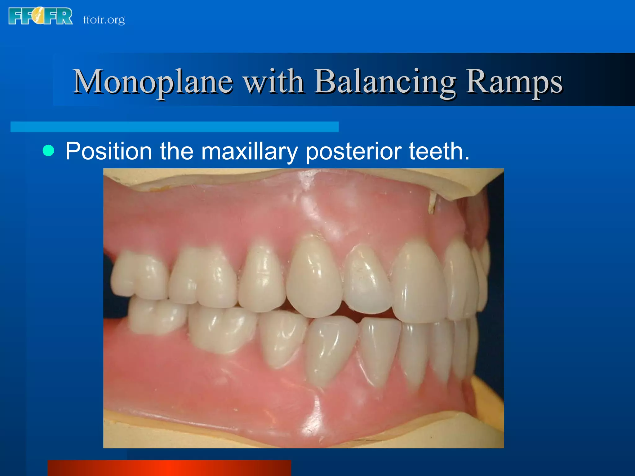 18.occlusal schemes monoplane with balancing ramps | PPT
