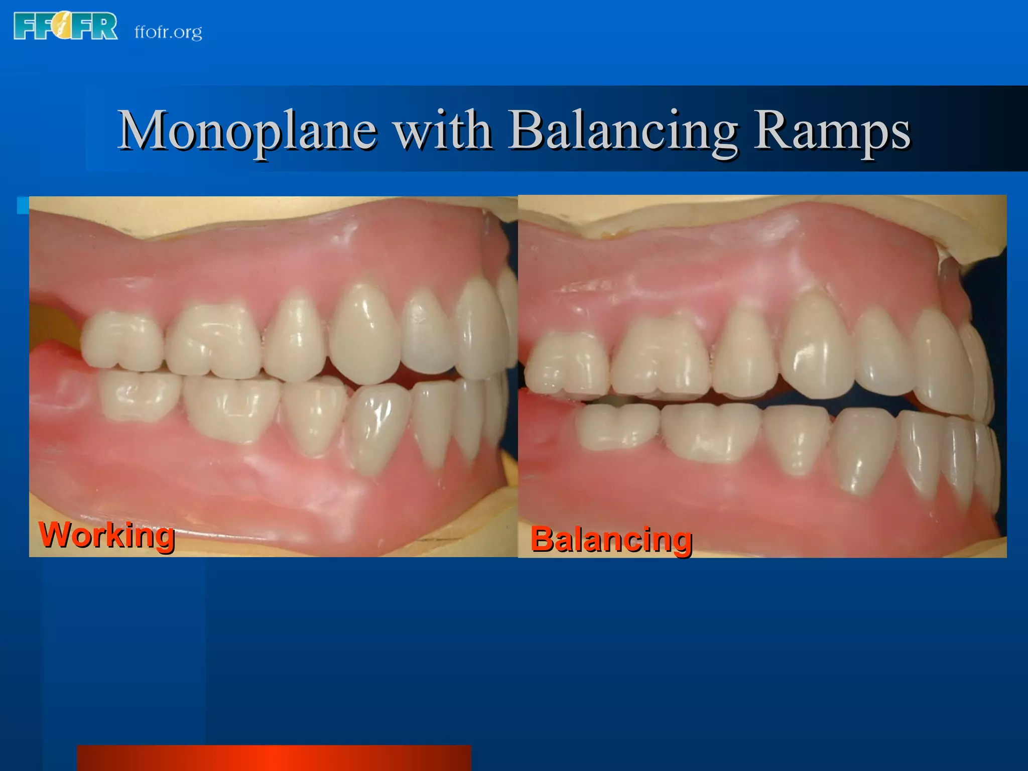 18.occlusal schemes monoplane with balancing ramps | PPT