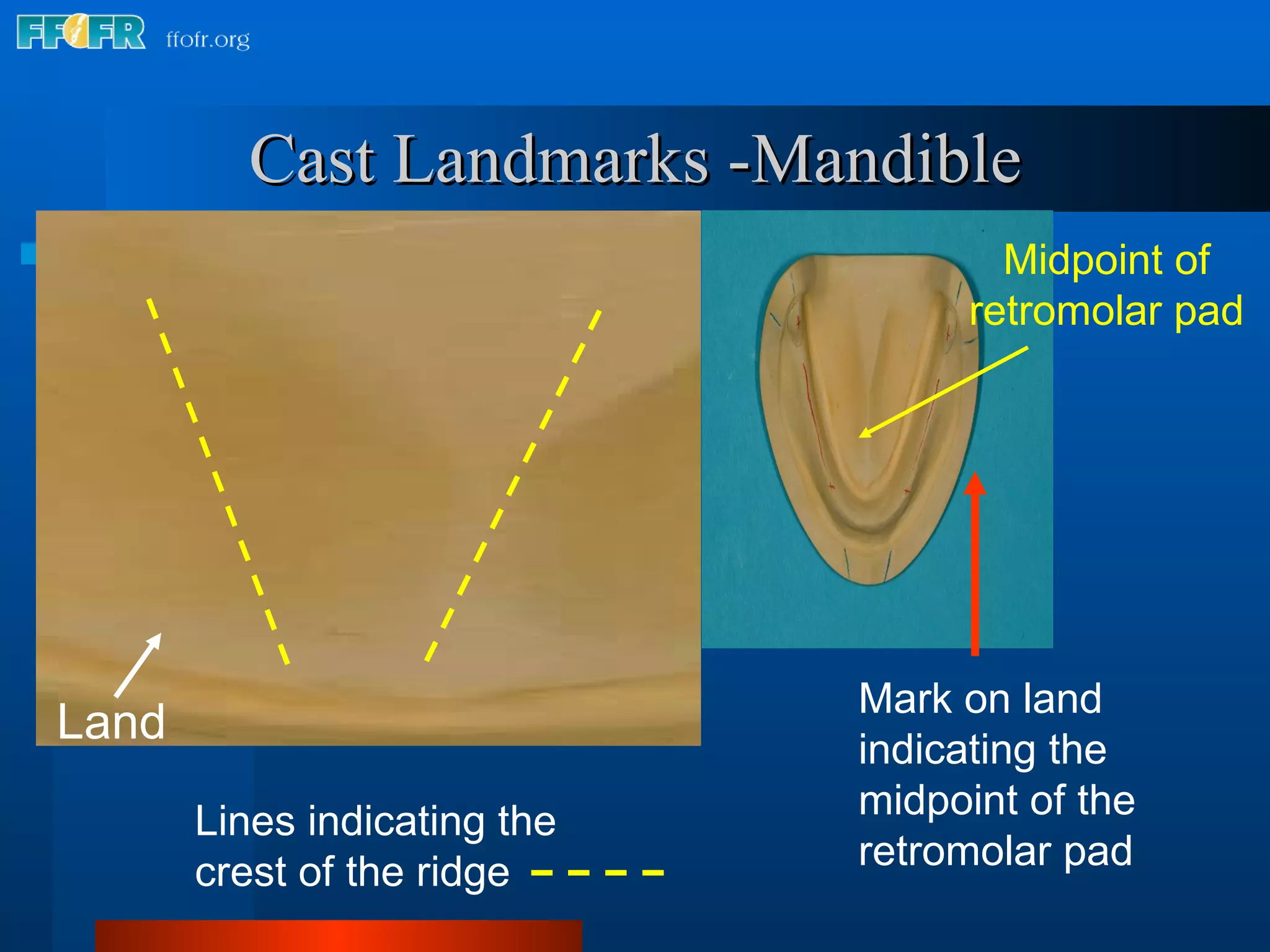 18.occlusal schemes monoplane with balancing ramps | PPT