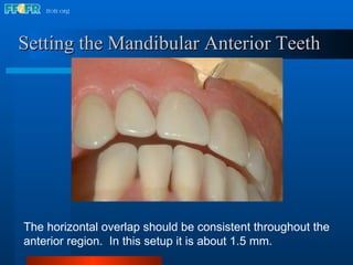 18.occlusal schemes monoplane with balancing ramps | PPT