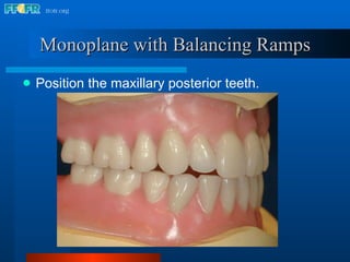 18.occlusal schemes monoplane with balancing ramps | PPT