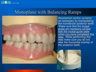 18.occlusal schemes monoplane with balancing ramps | PPT