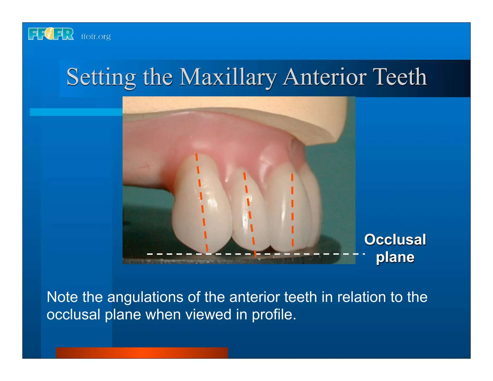 18.occlusal schemes monoplane with balancing ramps | PDF