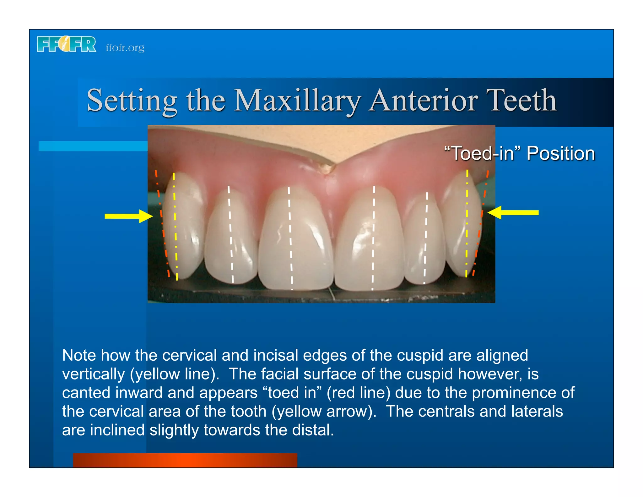 18.occlusal schemes monoplane with balancing ramps | PDF