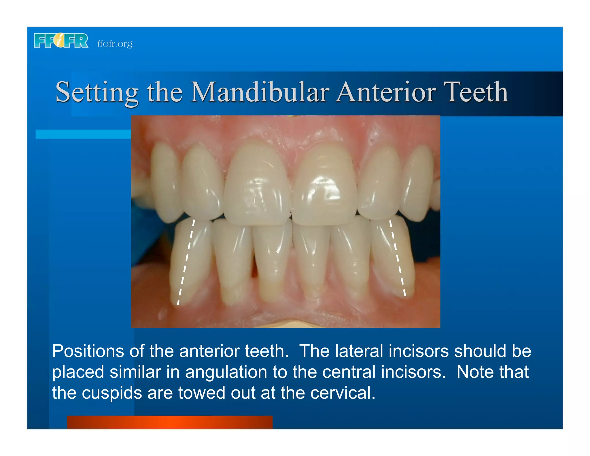 18.occlusal schemes monoplane with balancing ramps | PDF