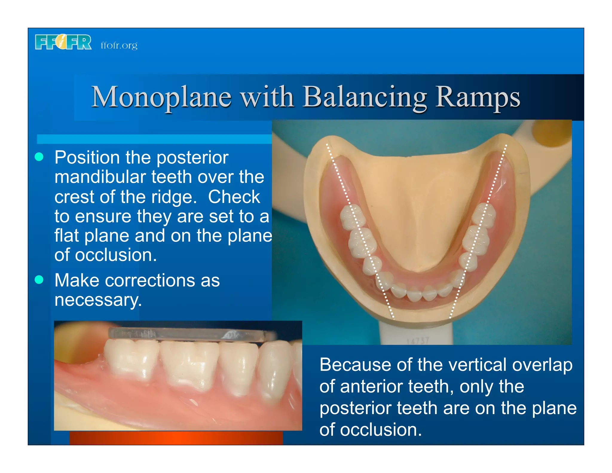 18.occlusal schemes monoplane with balancing ramps | PDF