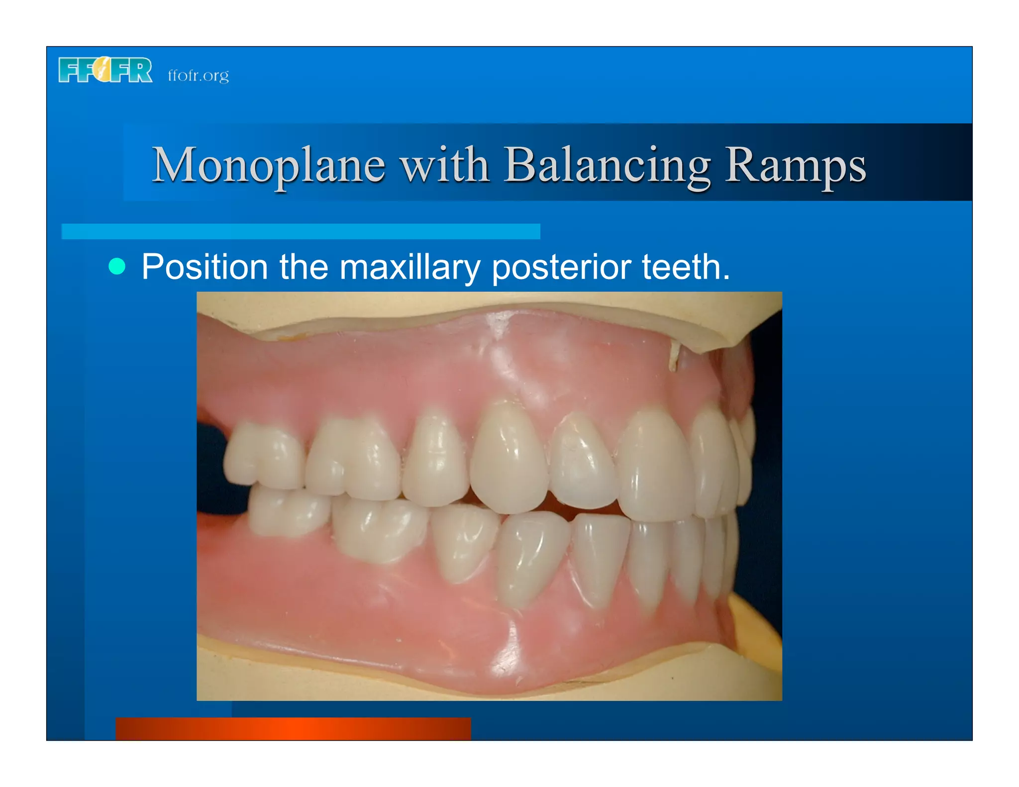18.occlusal schemes monoplane with balancing ramps | PDF