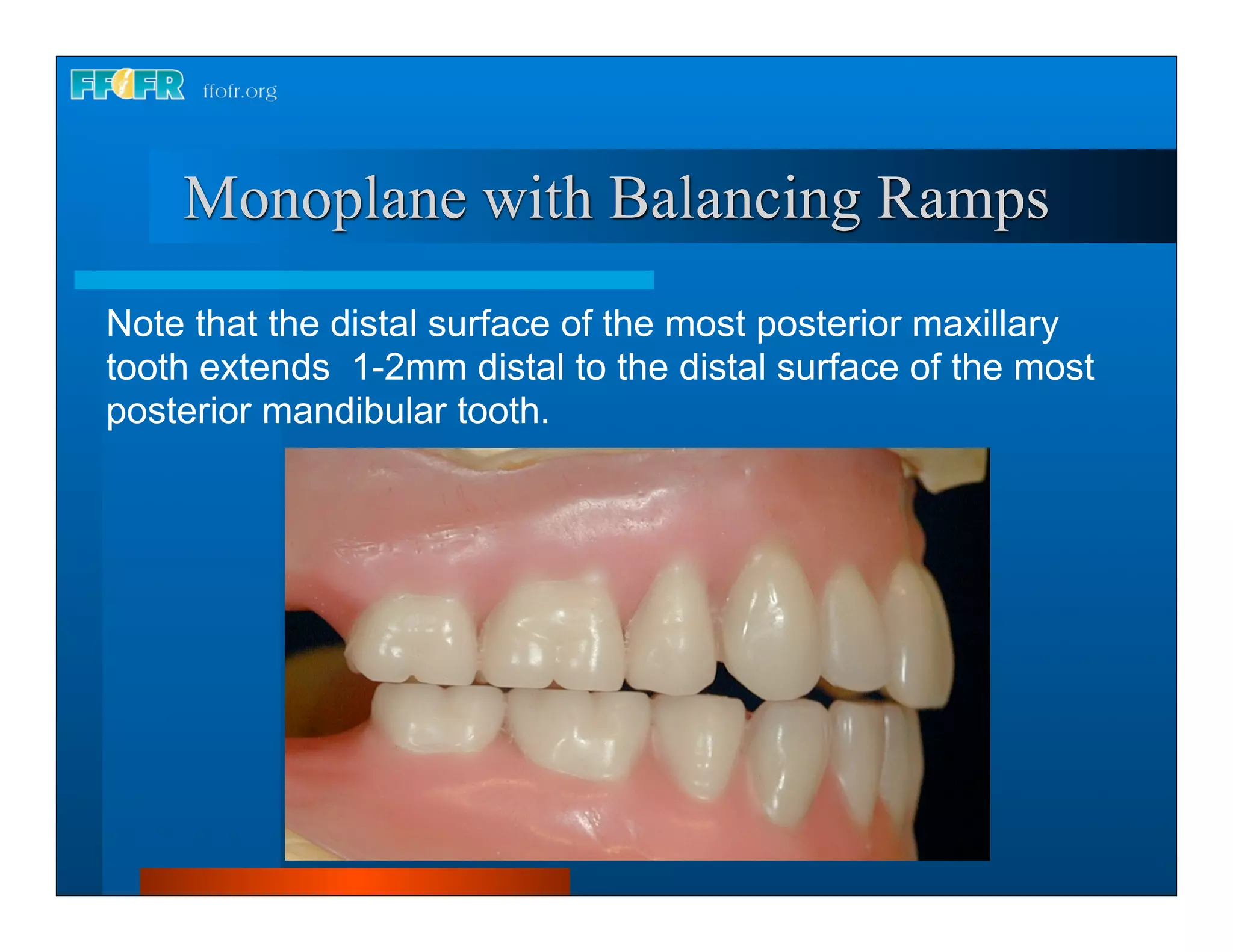 18.occlusal schemes monoplane with balancing ramps | PDF