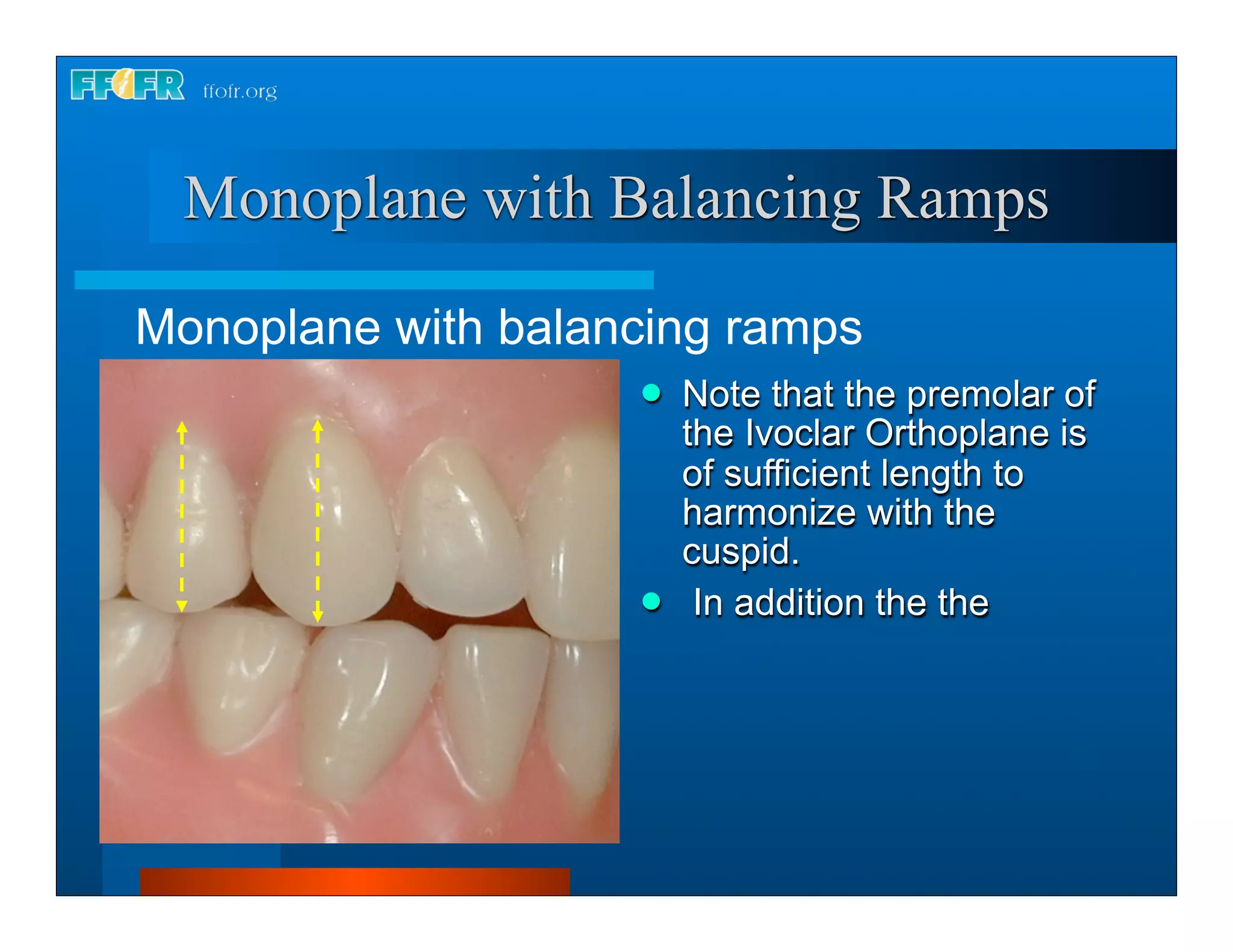 18.occlusal schemes monoplane with balancing ramps | PDF