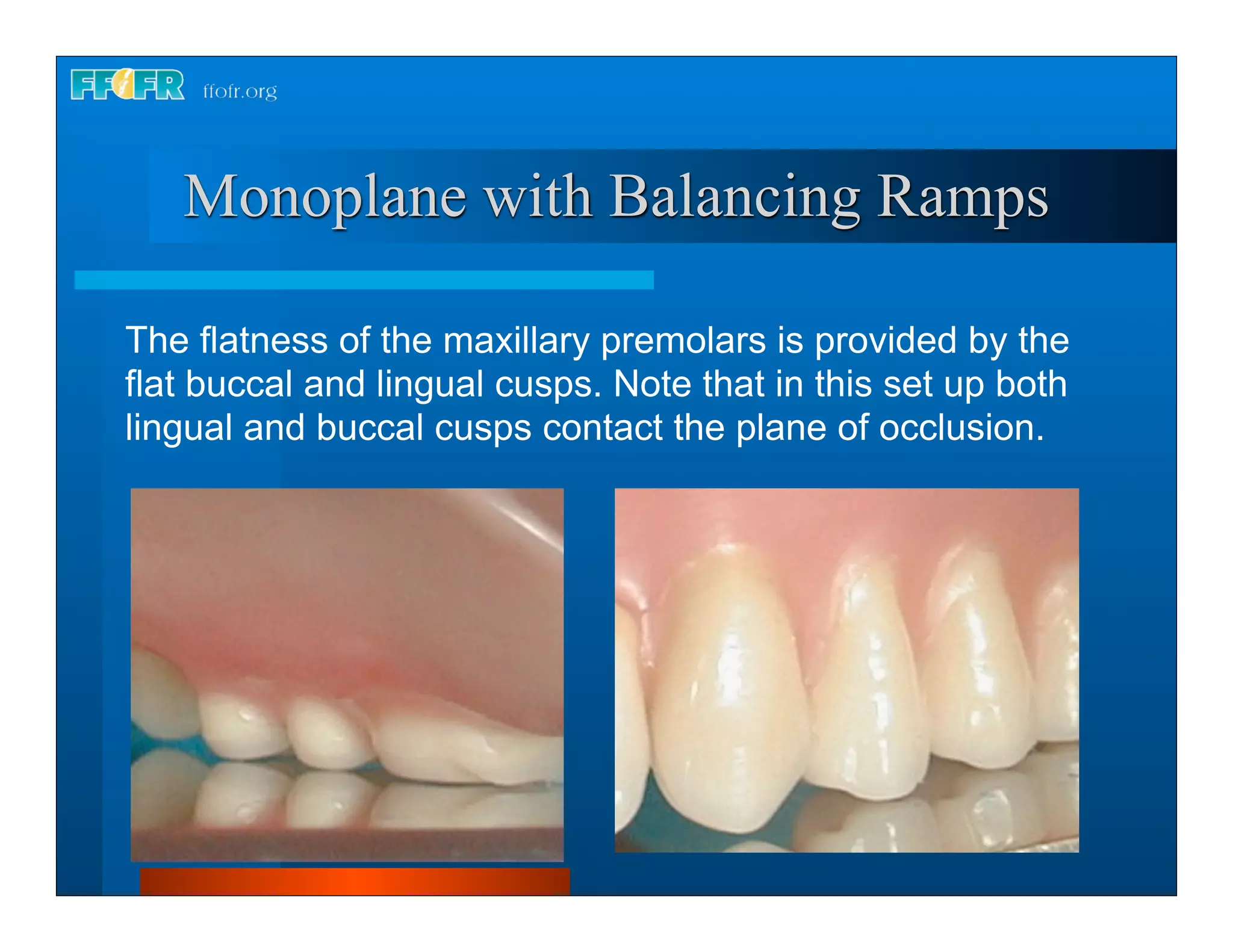 18.occlusal schemes monoplane with balancing ramps | PDF