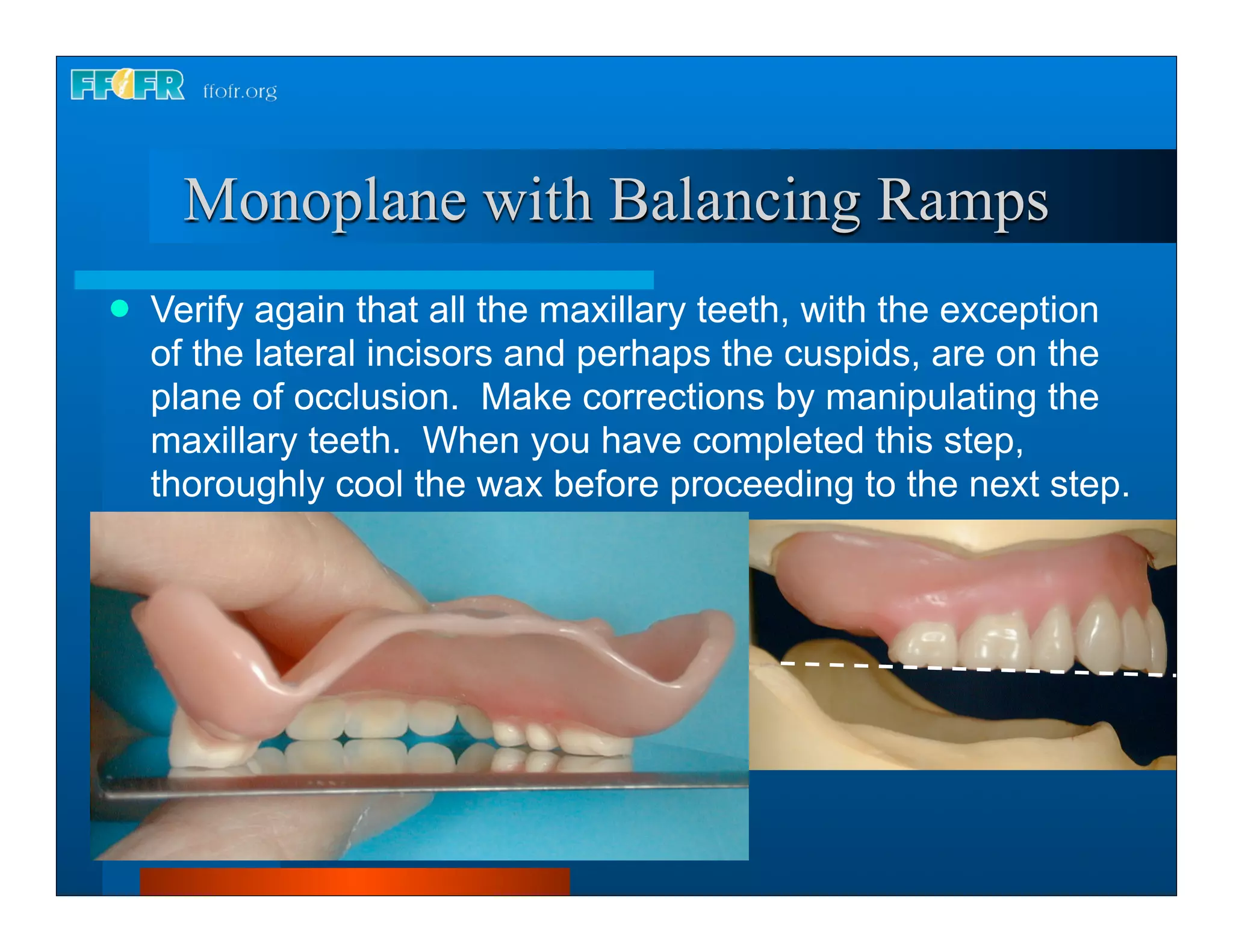 18.occlusal schemes monoplane with balancing ramps | PDF