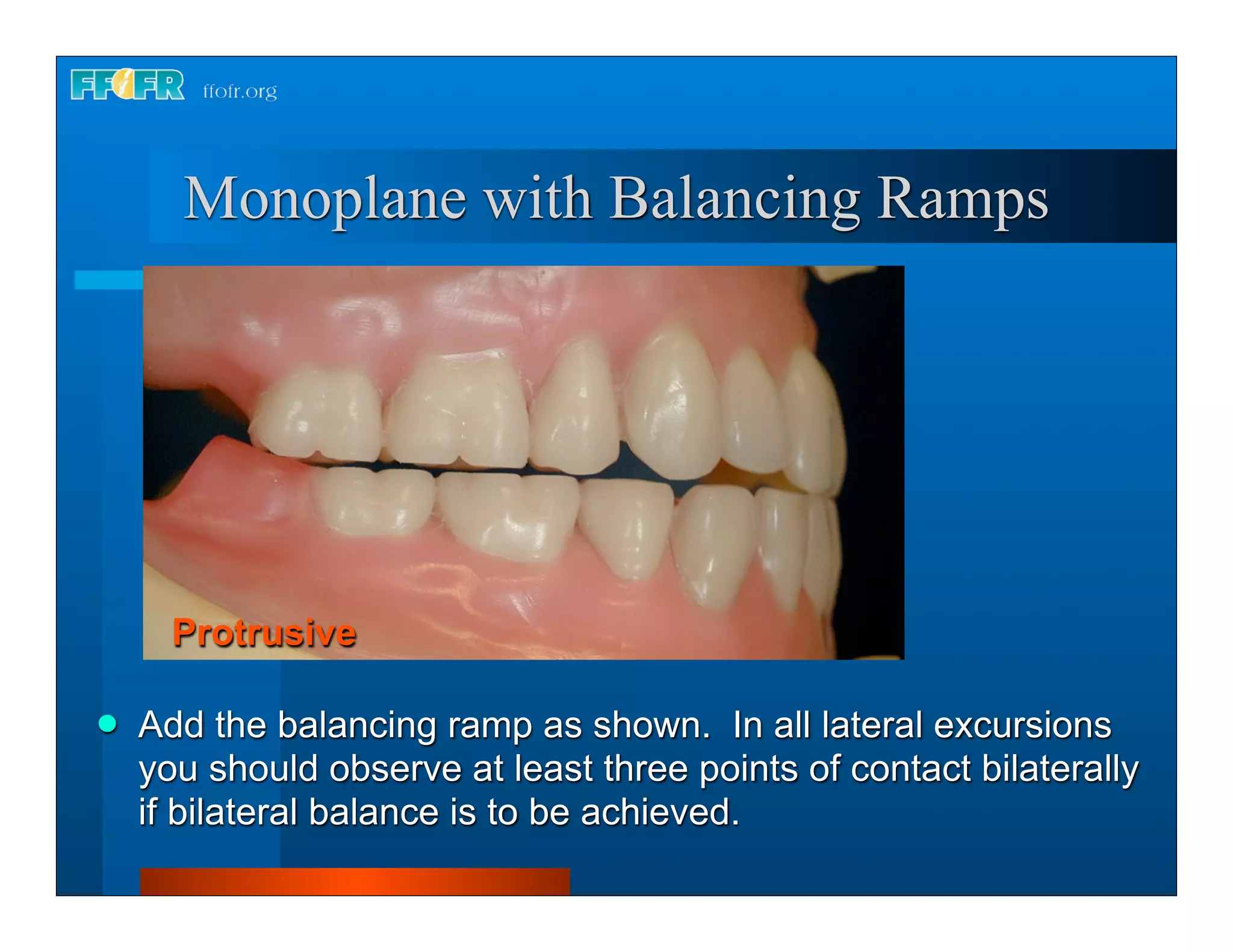 18.occlusal schemes monoplane with balancing ramps | PDF