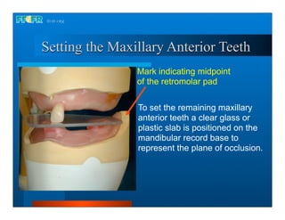 18.occlusal schemes monoplane with balancing ramps | PDF