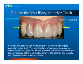 18.occlusal schemes monoplane with balancing ramps | PDF
