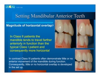 18.occlusal schemes monoplane with balancing ramps | PDF