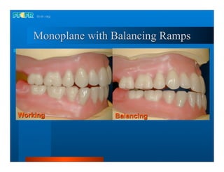 18.occlusal schemes monoplane with balancing ramps | PDF