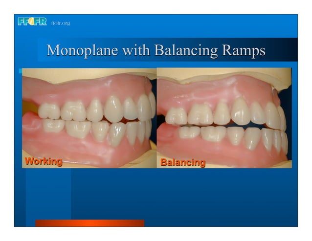 18.occlusal schemes monoplane with balancing ramps | PDF | Dental ...